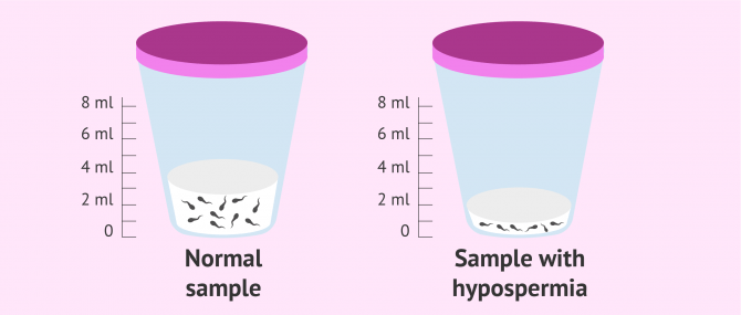 Hypospermia: low semen ejaculation in men