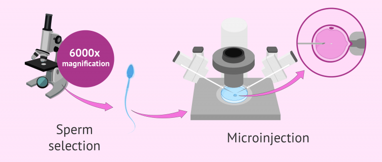 IMSI in IVF - differences to ICSI, advantages and disadvantages