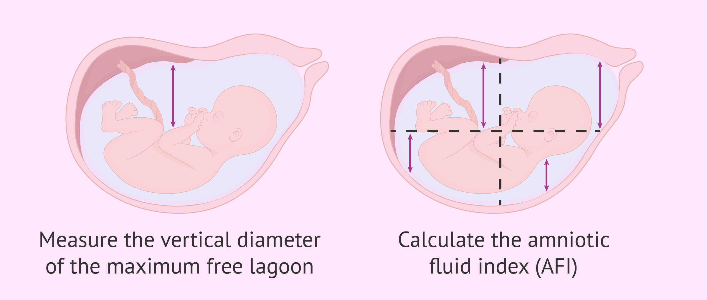 Measurement Of Amniotic Fluid Quantity Measurement Of Amniotic Fluid Quantity