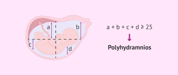 Diagnosis of polyhydramnios
