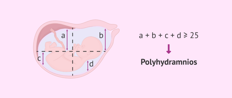 Diagnosis of polyhydramnios