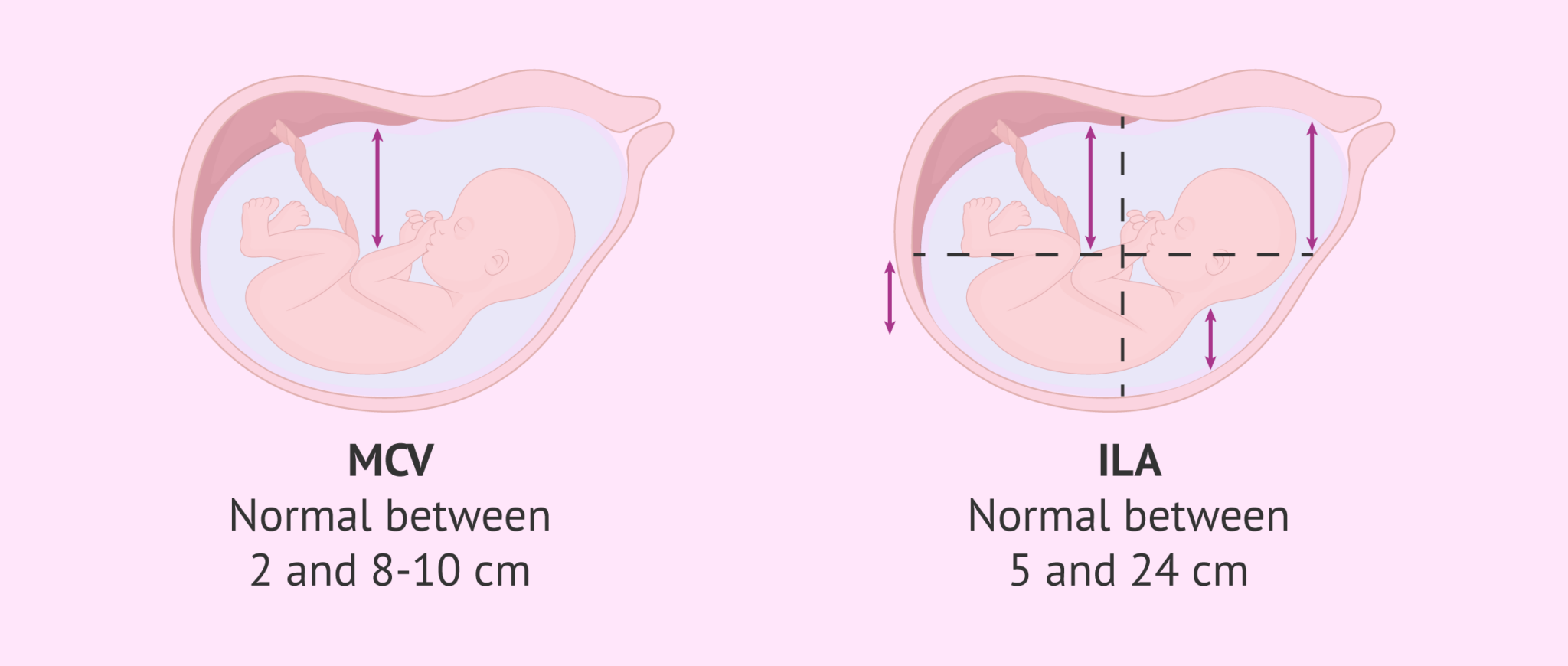 Amniotic fluid abnormalities: causes, symptoms and treatment