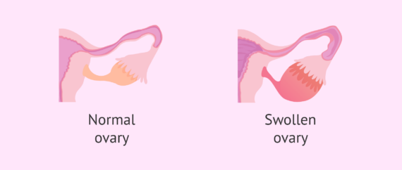 Ovarian inflammation: main causes and symptoms