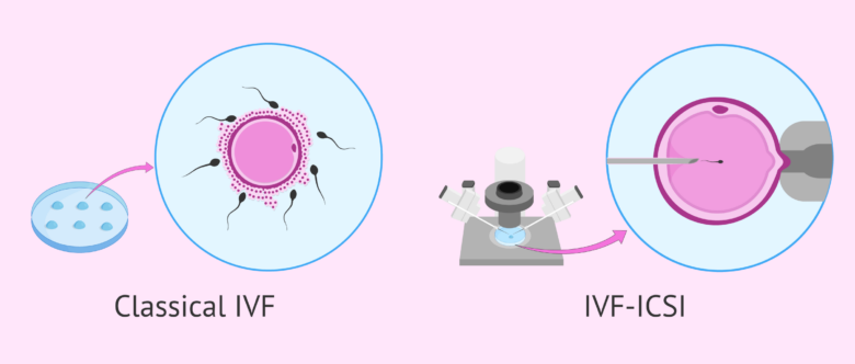 IVF or ICSI: What is the difference? Which is better?
