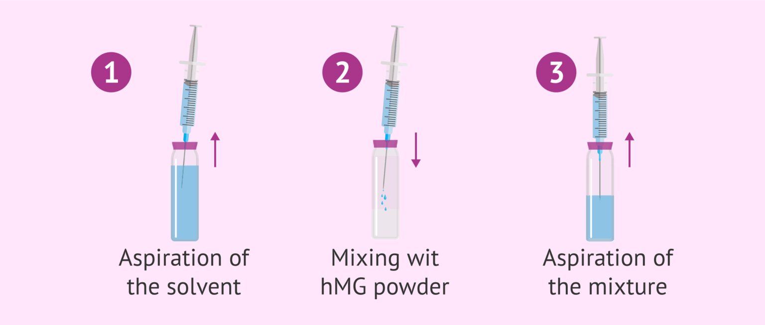 hMG (human menopausal gonadotropin): administration and price