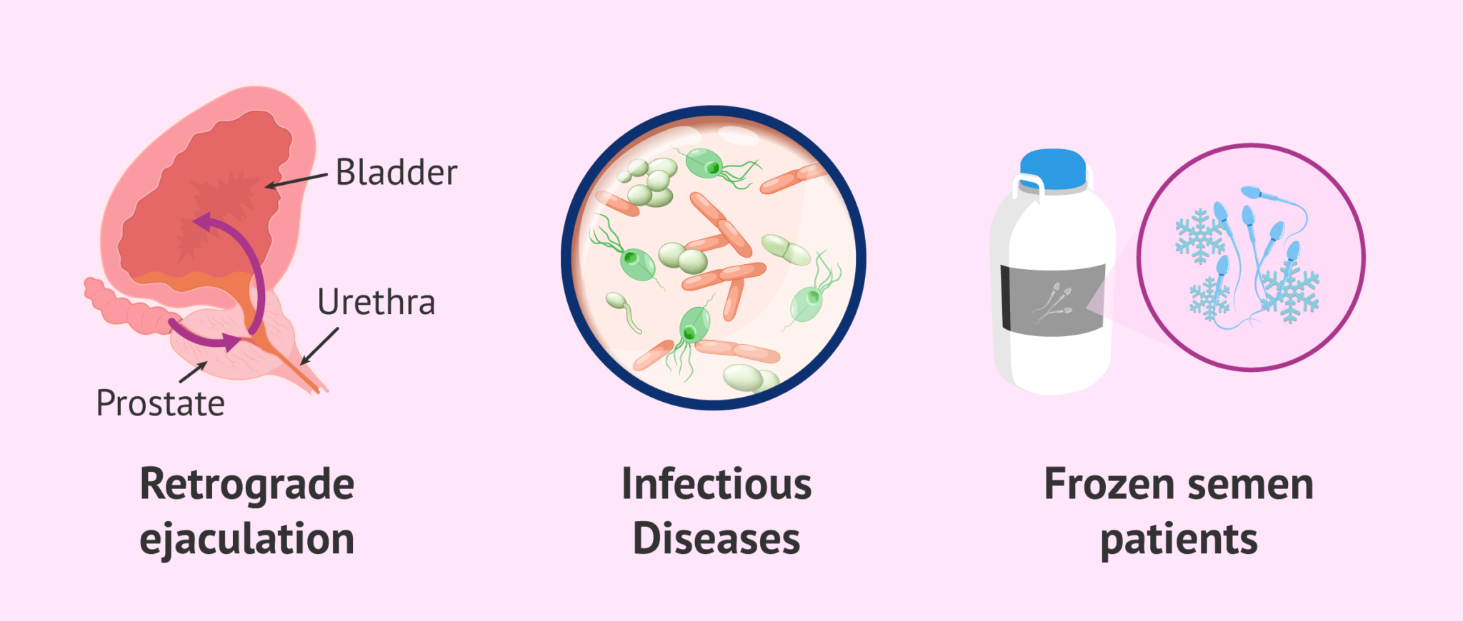 Indications for ICSI: when is it necessary?