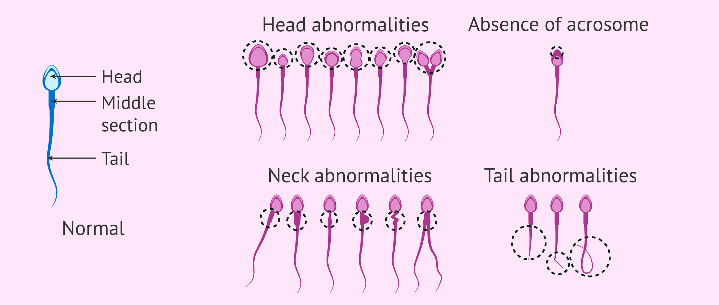 What Is Sperm Morphology Meaning Normal Range What Is Sperm Morphology Meaning Normal Range