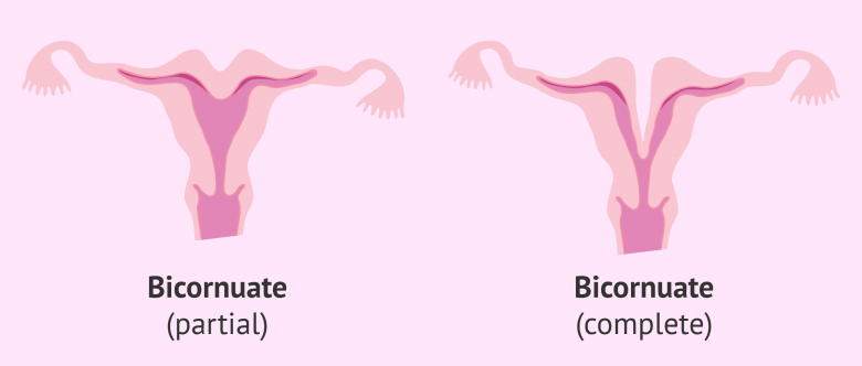 Types of bicornuate uterus