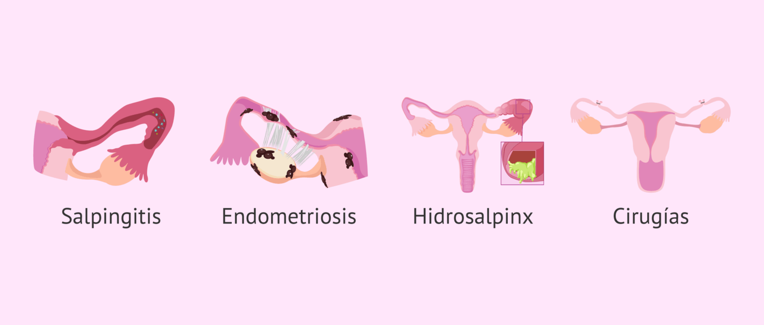 Blocked Fallopian Tubes - Causes, Diagnosis & Treatment