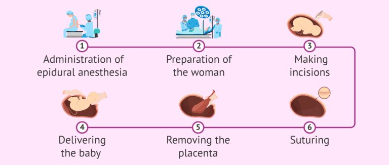 Cesarean section procedure for childbirth