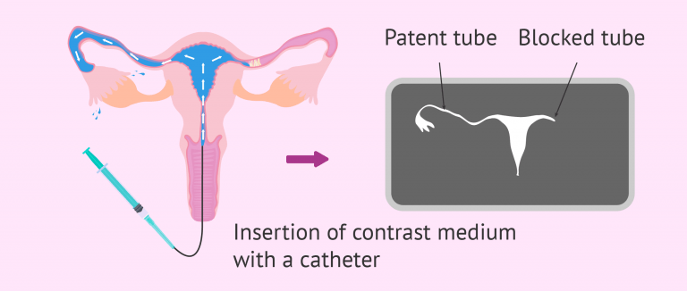 Blocked Fallopian Tubes - Causes, Diagnosis & Treatment