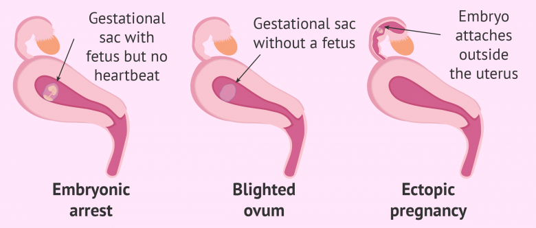 How many types of miscarriage are there and how do they differ?