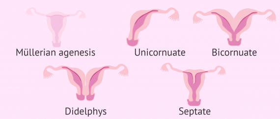 Uterus Tipped Backwards: Causes & Symptomes of Retroverted Uterus