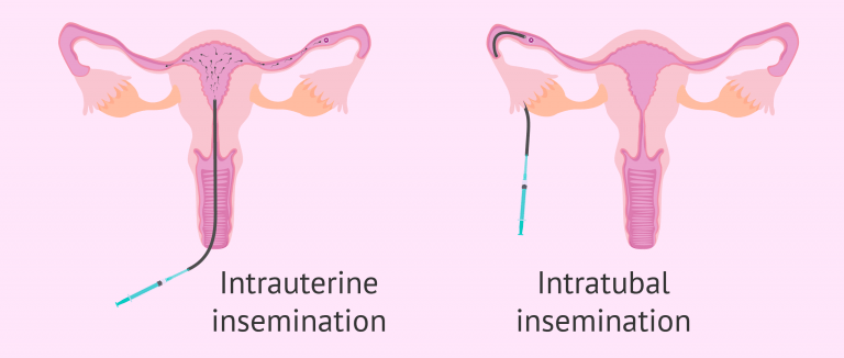 Intrauterine vs. intratubal insemination