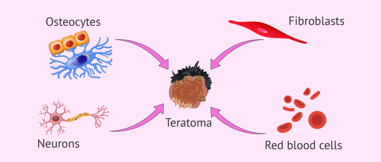 Ovarian Teratoma - Can It Contain Teeth, Hair & Other Organs?