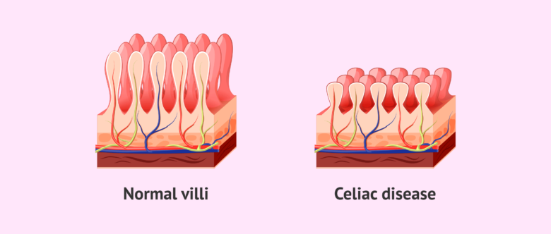 Can celiac disease cause infertility? - Diagnosis and treatment