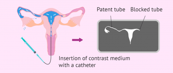 HSG and blocked fallopian tubes