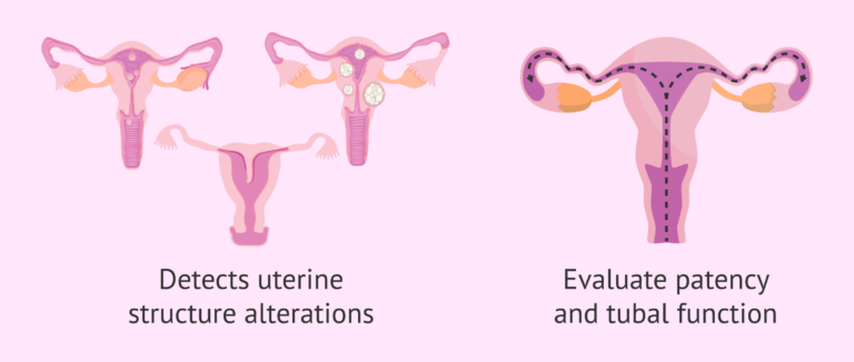 Hysterosalpingo-Contrast-Sonography (HyCoSy): process and tips