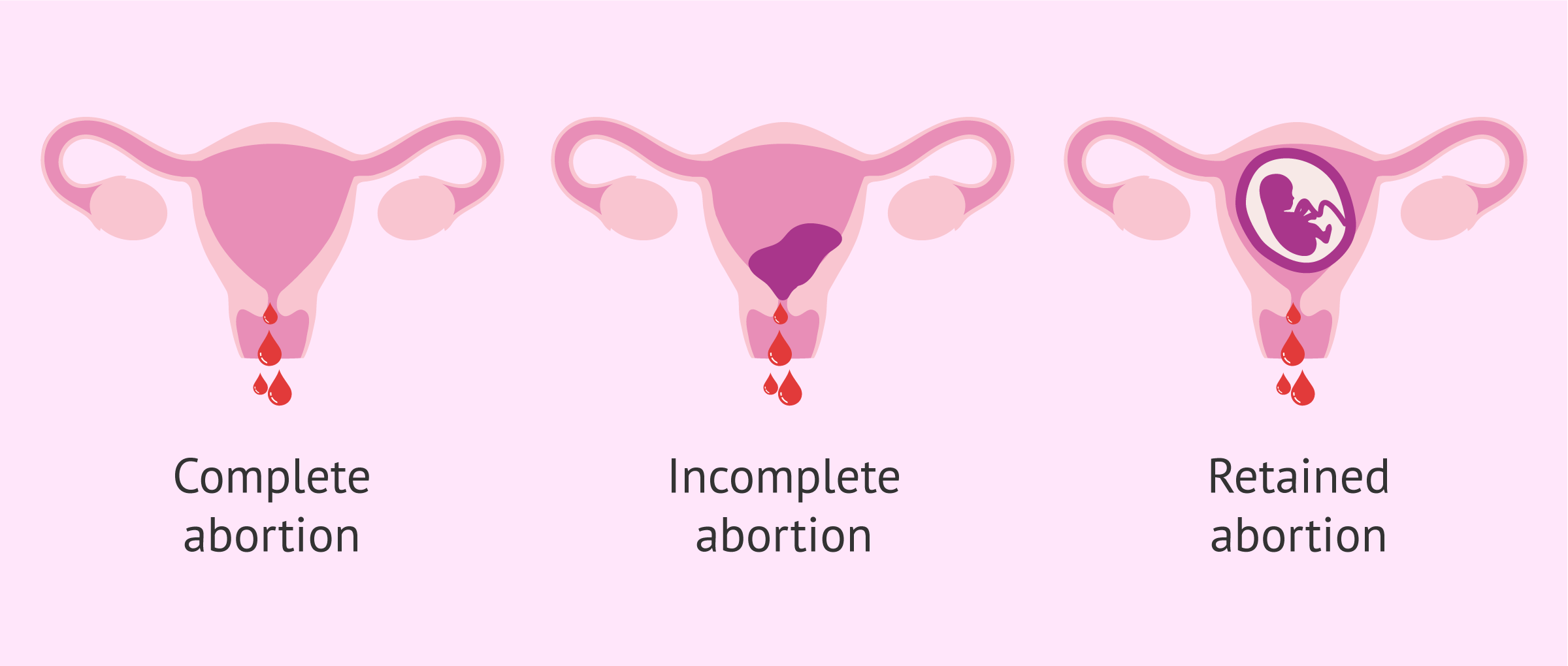 Types Of Abortion According To Clinical Variety Types Of Abortion According To Clinical Variety