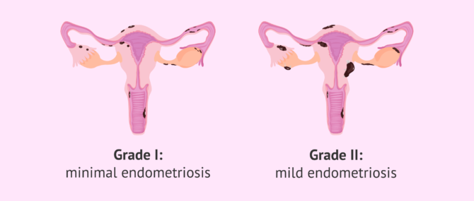 Endometriosis grade I and II