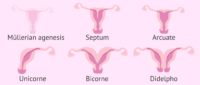 What Are Müllerian Duct Anomalies? - Classification with Pictures