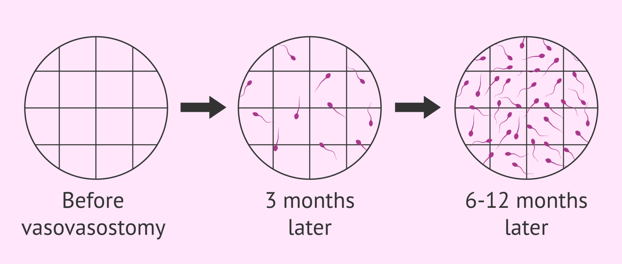 Seminogram results after vasovasostomy