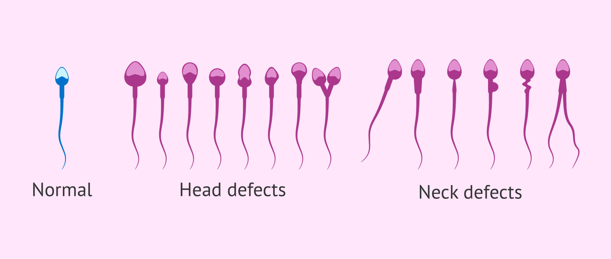 Sperm defects and natural pregnancy