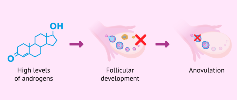 Fertility in women with PCOS