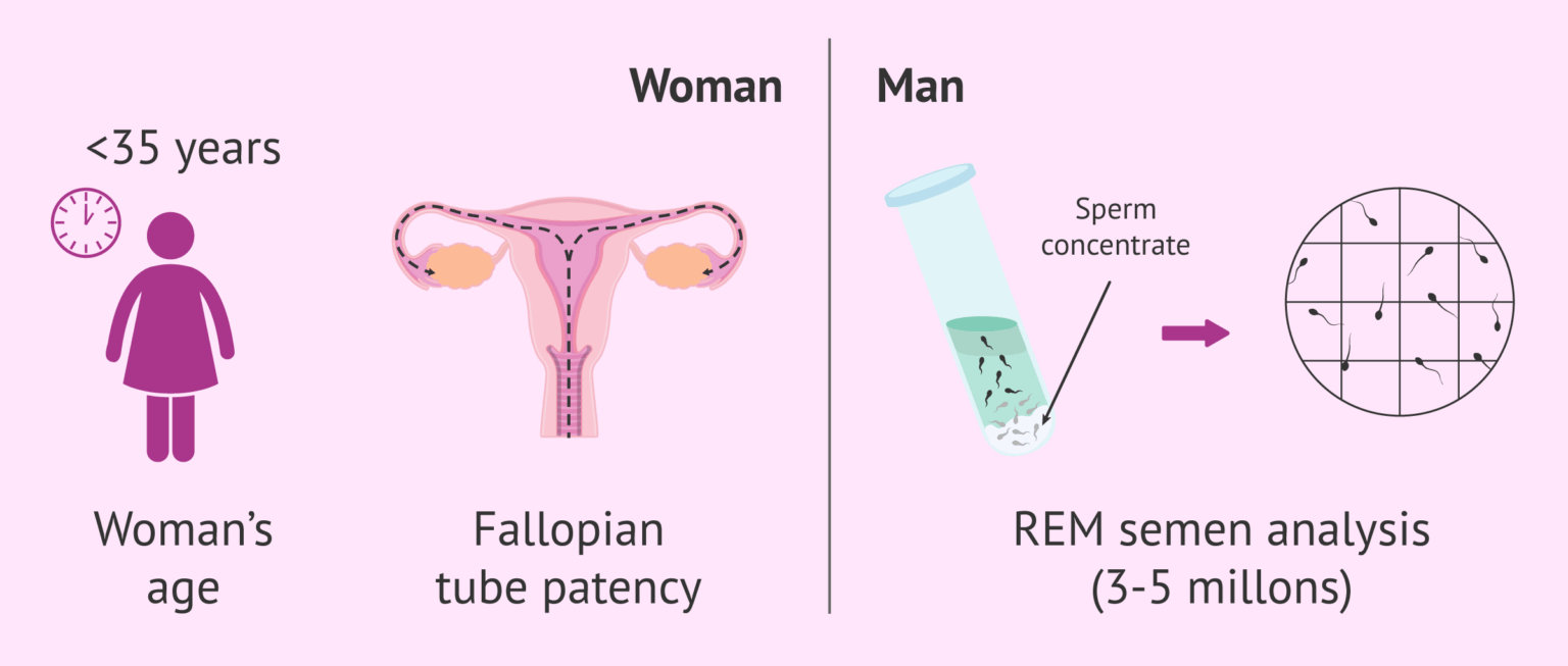 IUI in men with oligozoospermia