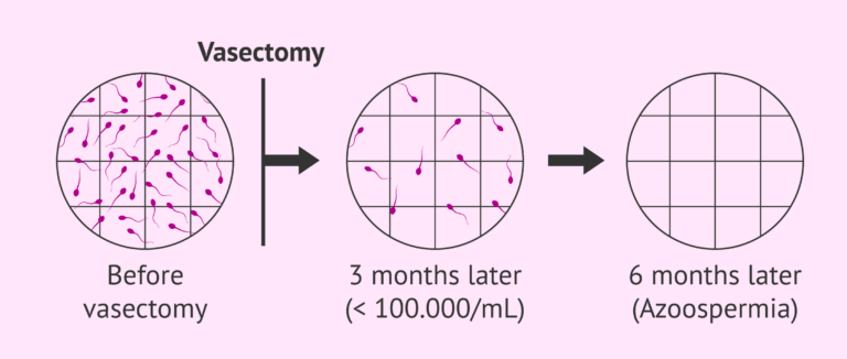 Why does vasectomy cause azoospermia?
