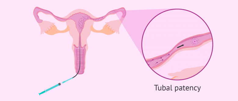 Egg fertilization in Fallopian tube