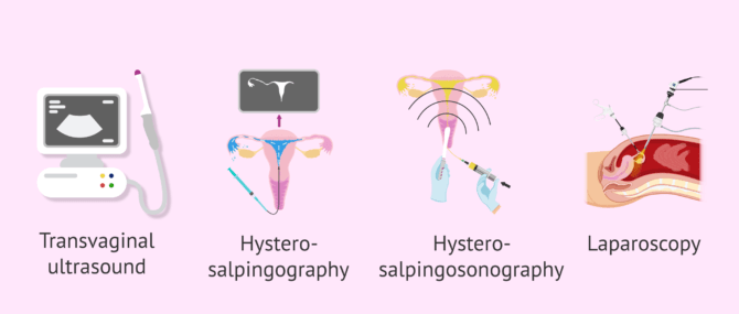 Female infertility due to tubal factor: causes and treatments