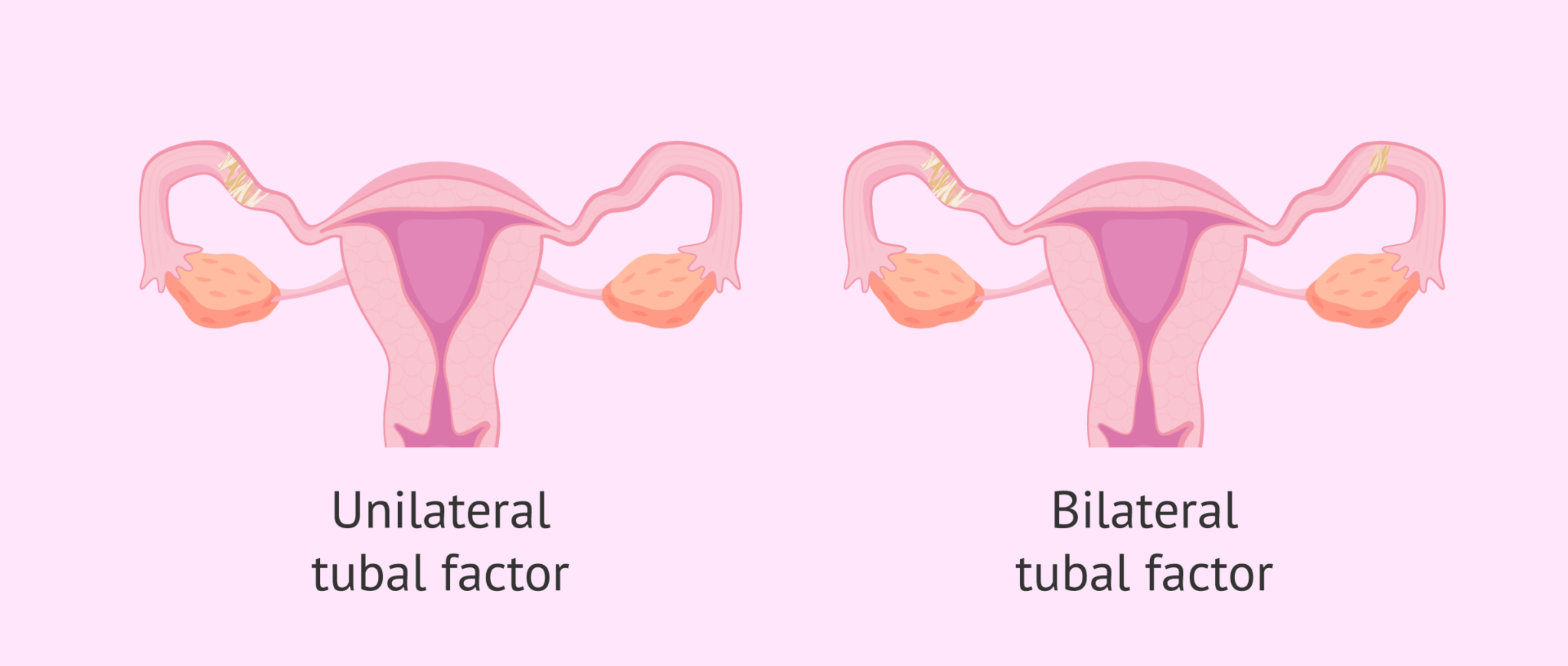 Blocked Fallopian Tubes - Causes, Diagnosis & Treatment
