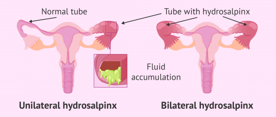 Hydrosalpinx: what is it, what causes it and how to treat it.