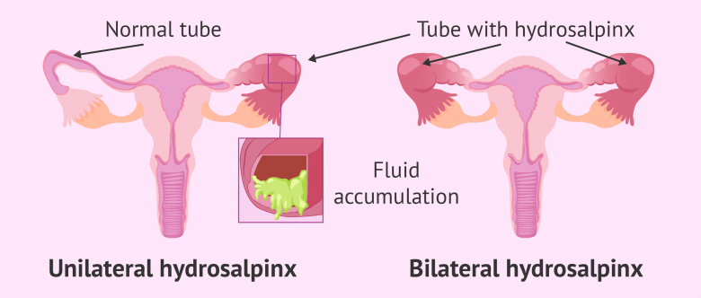 Hydrosalpinx: what is it, what causes it and how to treat it.