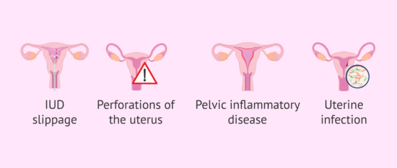 What are the risks of IUD use?
