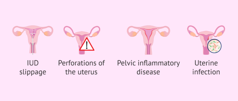 What are the risks of IUD use?