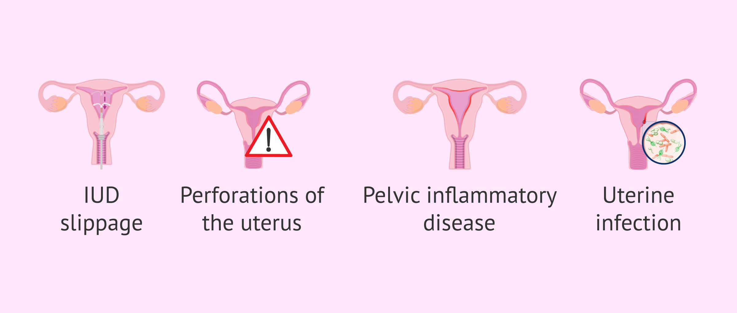 Iud Side Effects Cks Iud Side Effects Cks