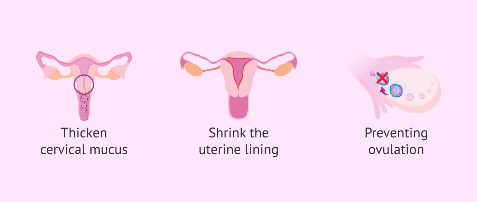 Effects of hormonal IUD