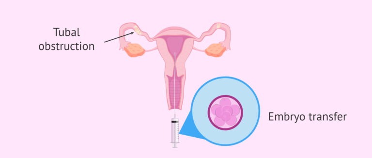 IVF with tubal obstruction