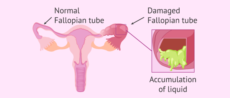 Normal Fallopian tube and Fallopian tube with hydrosalpinx