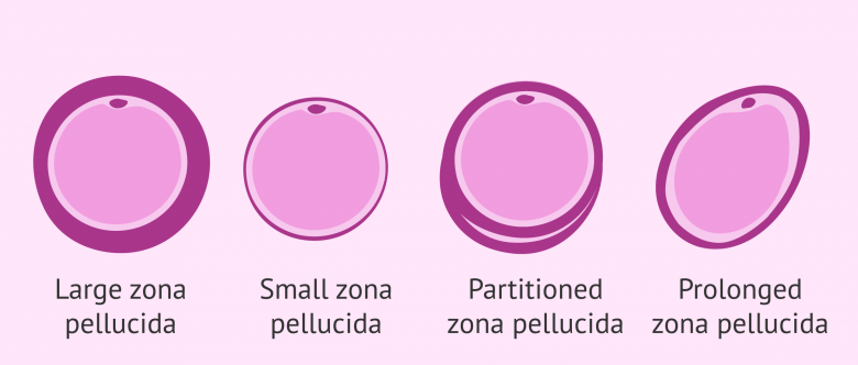 Alterations in the zona pellucida