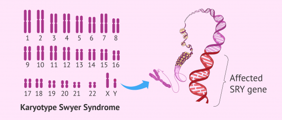 Swyer's syndrome: causes, symptoms and possibility of pregnancy