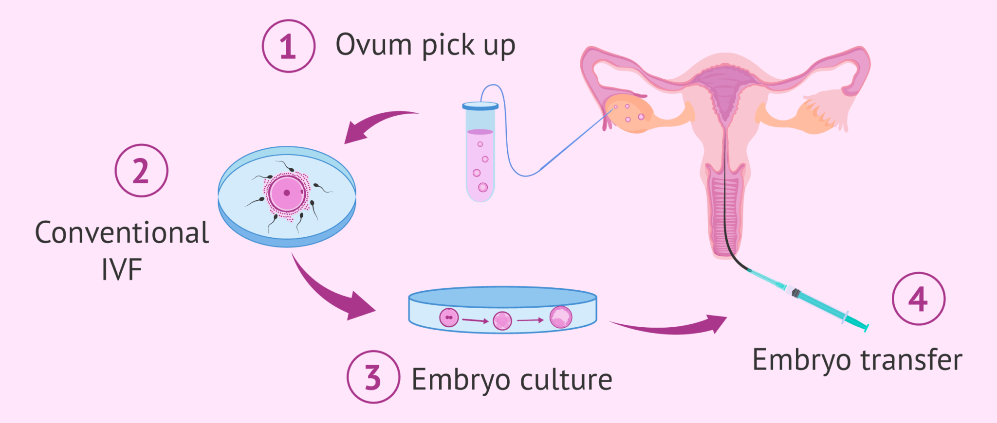 Steps In Conventional IVF