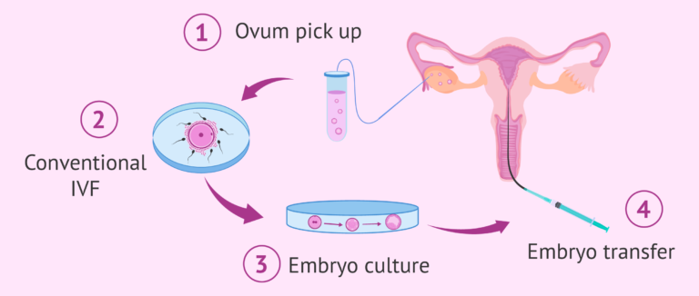 Steps in conventional IVF