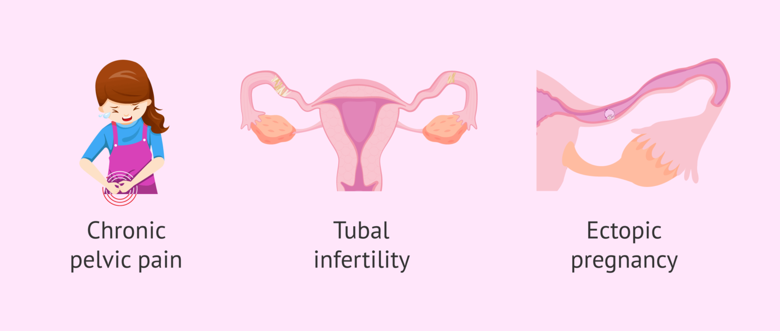 What Is Salpingitis? Causes, Symptoms & Treatment