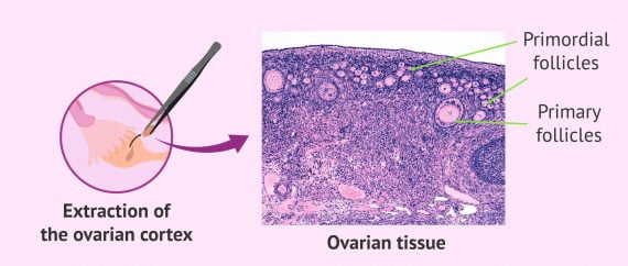 Ovarian cortex tissue