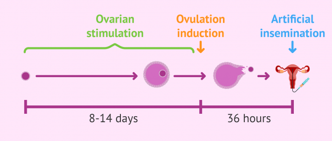 What Is the Ovarian Hyperstimulation Syndrome (OHSS)?