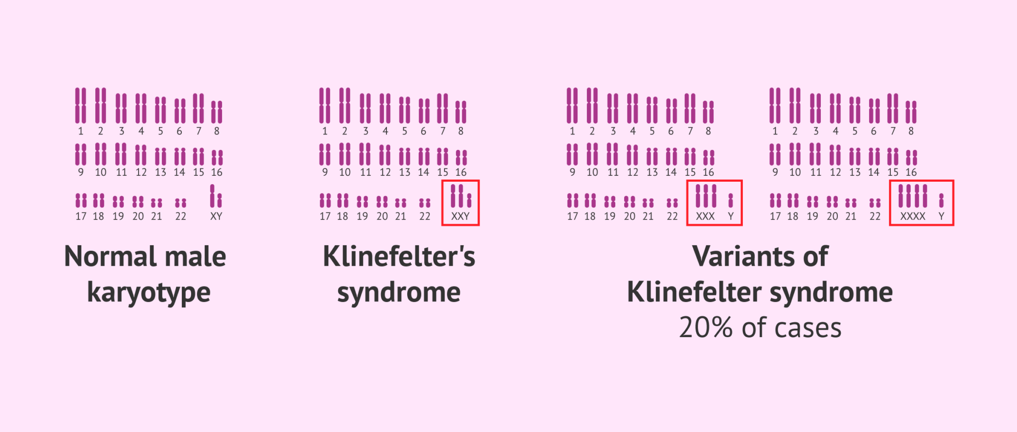 Klinefelter Syndrome (XXY Syndrome) - Symptoms, & Causes
