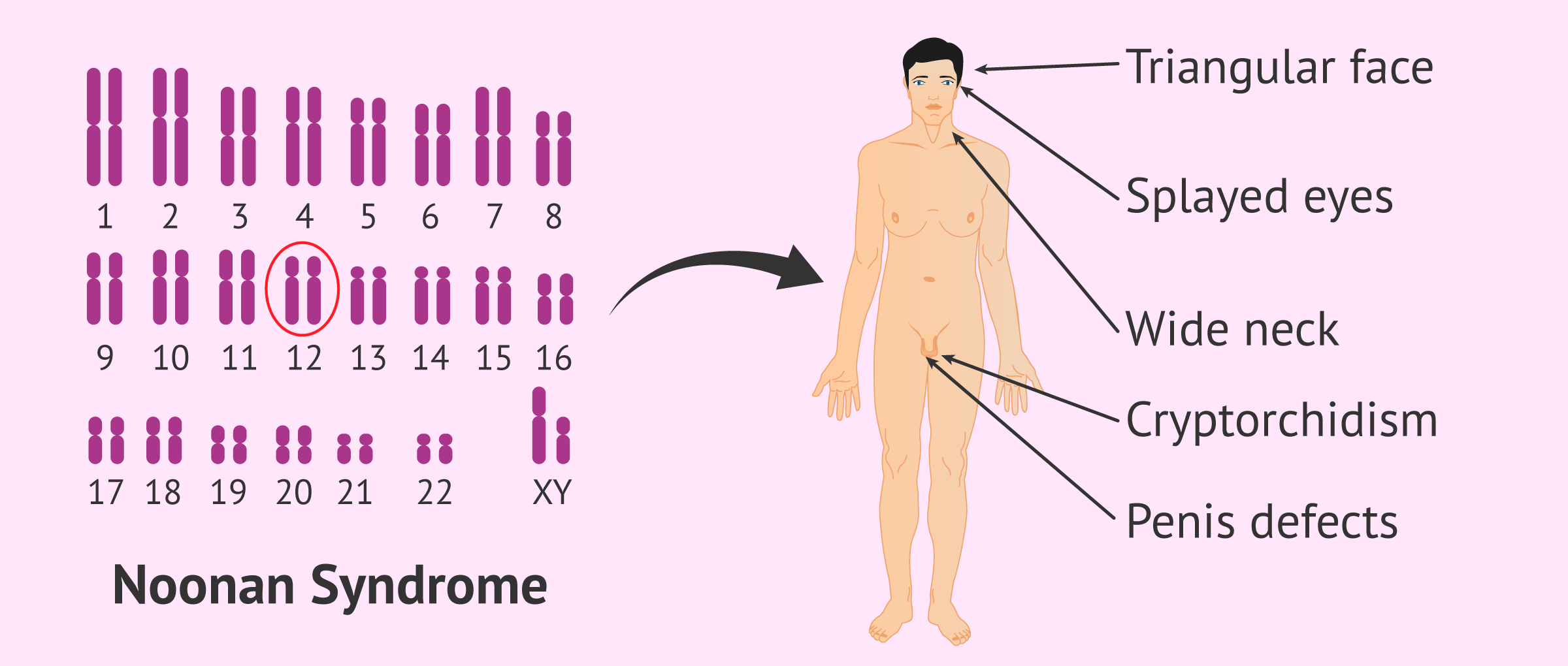 Noonan Syndrome Adults